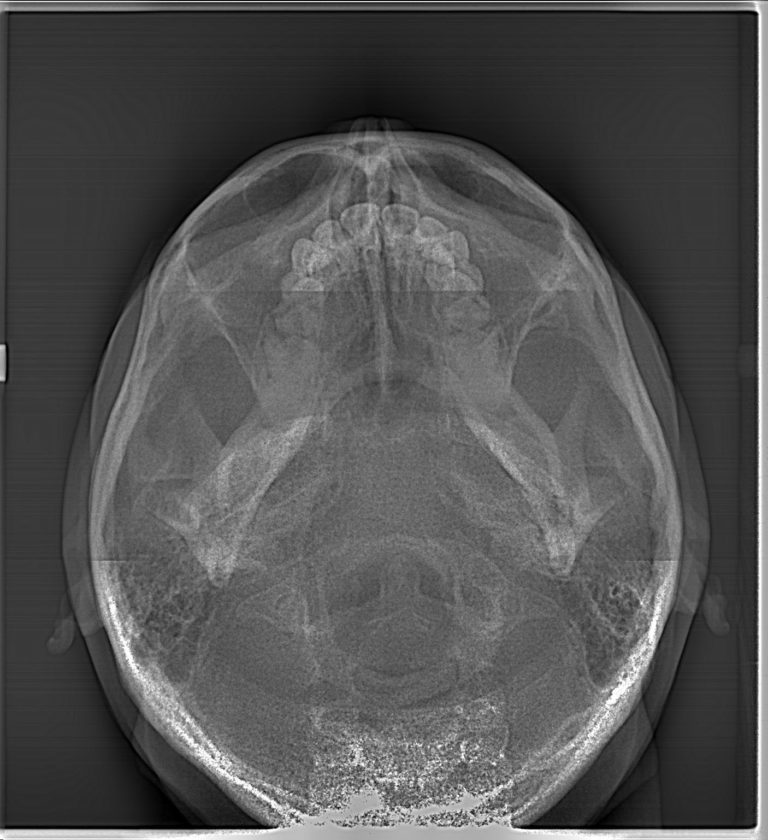 RX extraorales 2D – Radiológico Oral Ciudad Salitre